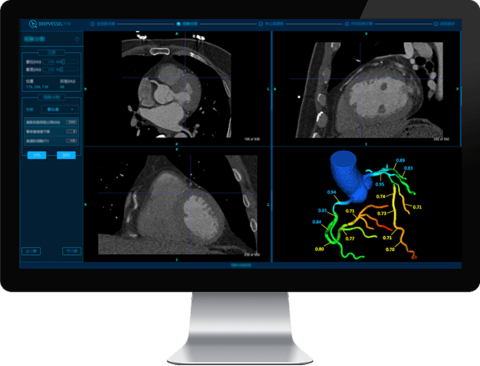 AI CT FFR: Precise Diagnosis of Coronary Artery Disease - KeyaMedical