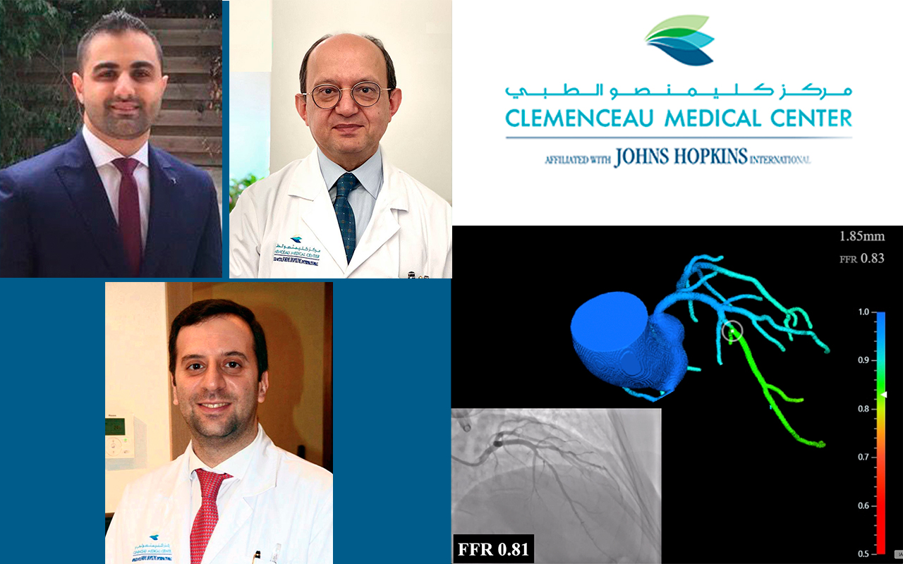 AI CT FFR: Precise Diagnosis of Coronary Artery Disease - KeyaMedical